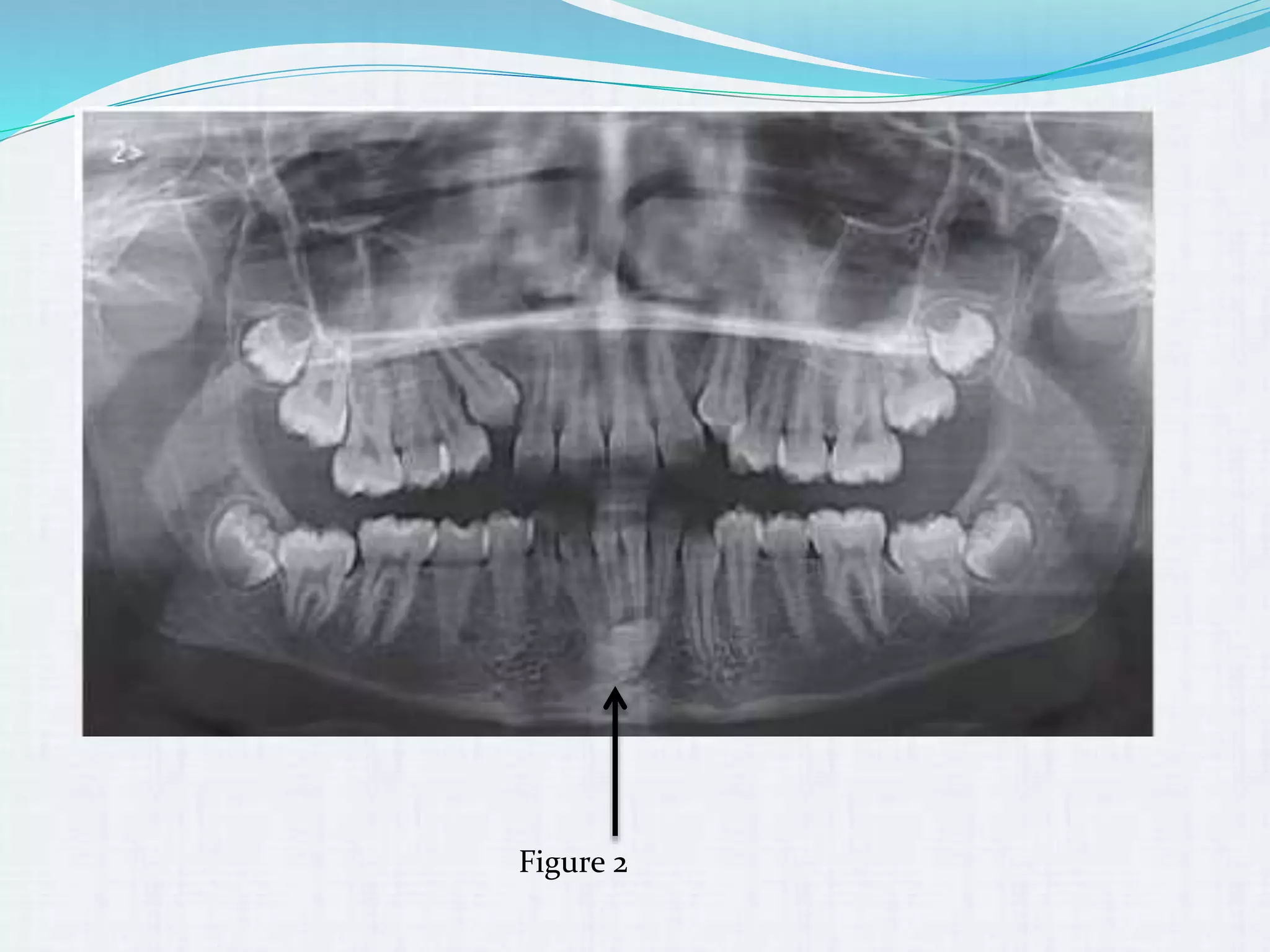 Extraction teeth for gaining space in orthodontics | PPT