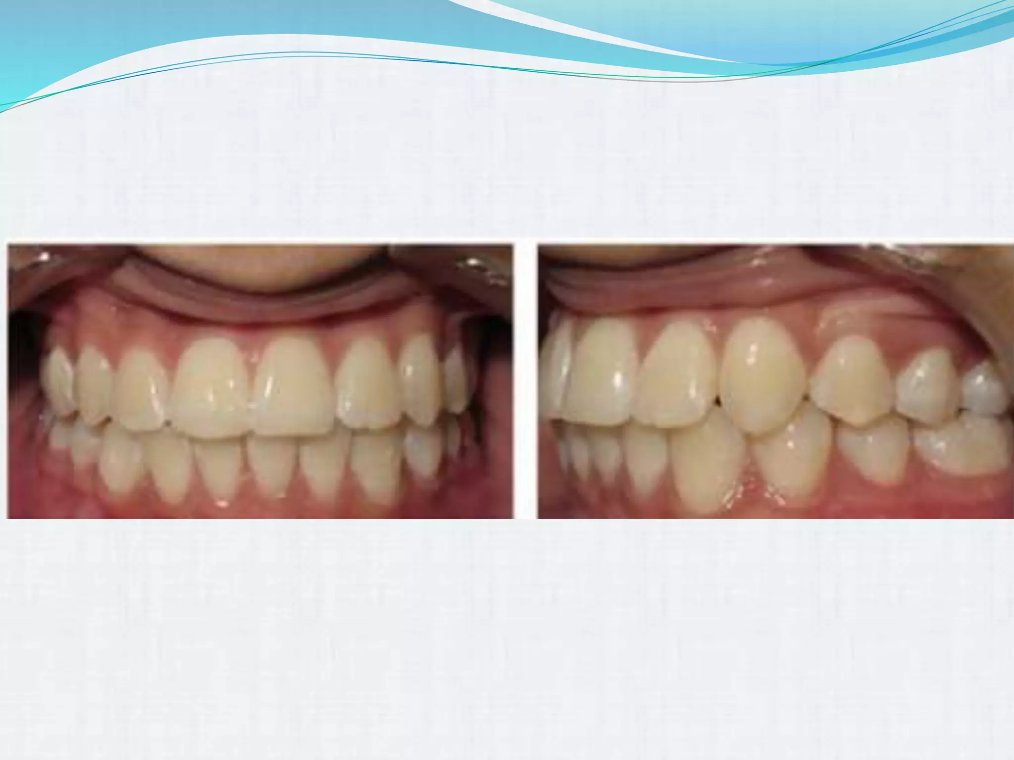 Extraction teeth for gaining space in orthodontics | PPT