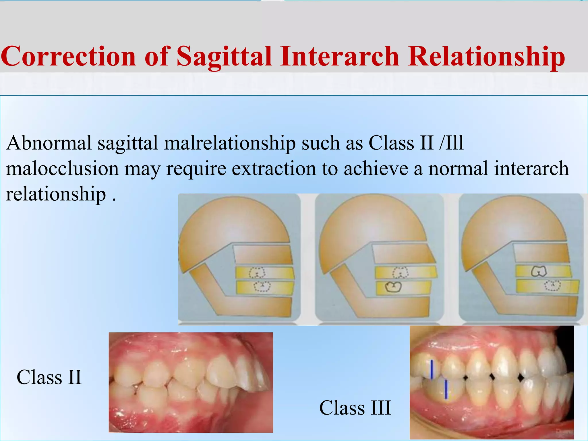 Extraction teeth for gaining space in orthodontics | PPTX