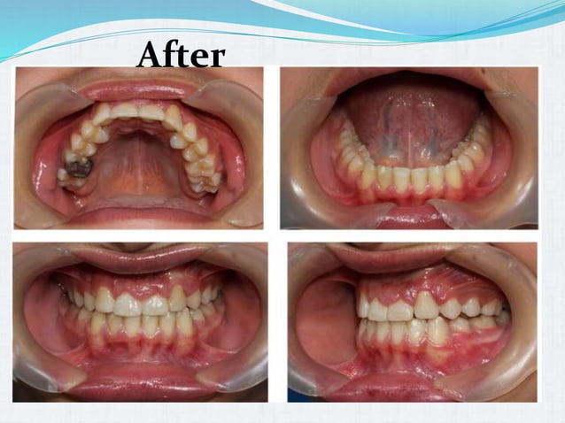 Extraction teeth for gaining space in orthodontics | PPT