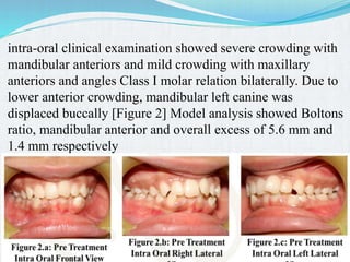 Extraction teeth for gaining space in orthodontics | PPTX
