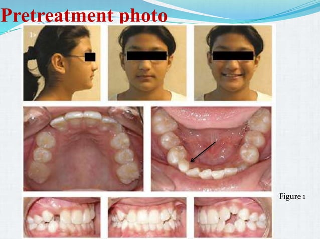 Extraction teeth for gaining space in orthodontics | PPT