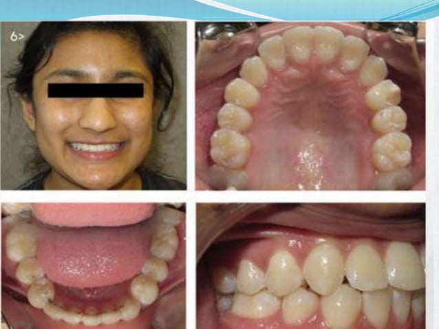 Extraction teeth for gaining space in orthodontics | PPT