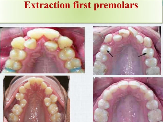Extraction teeth for gaining space in orthodontics | PPT