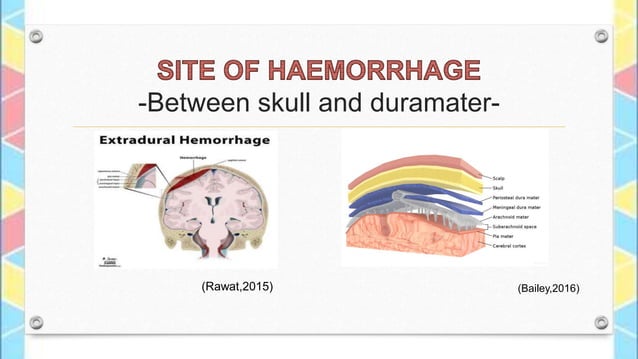 Extradural HAEMORRHAGE (i-learn) CNS System | PPTX | Death, Injury, or ...