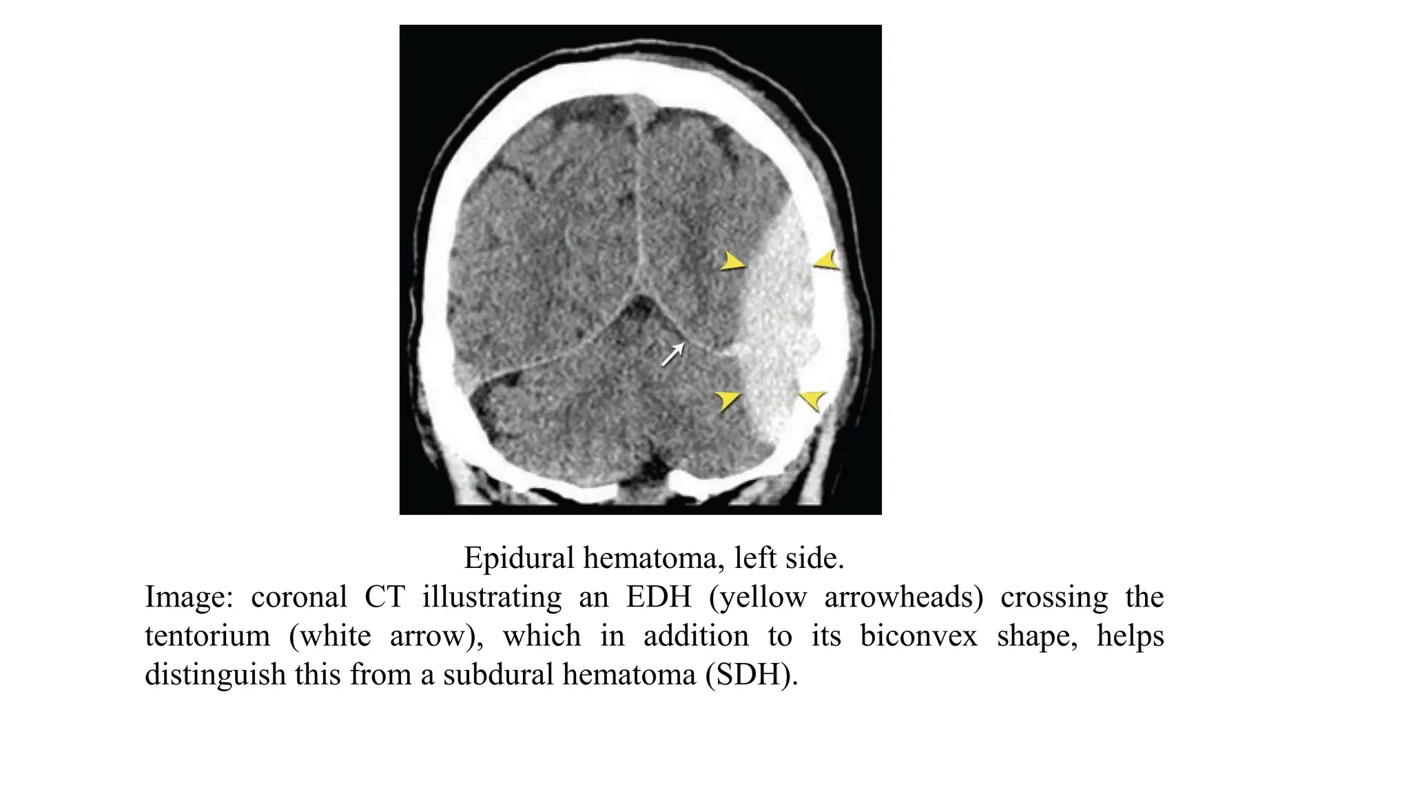 Extradural hemorrhage by Momen | PPTX