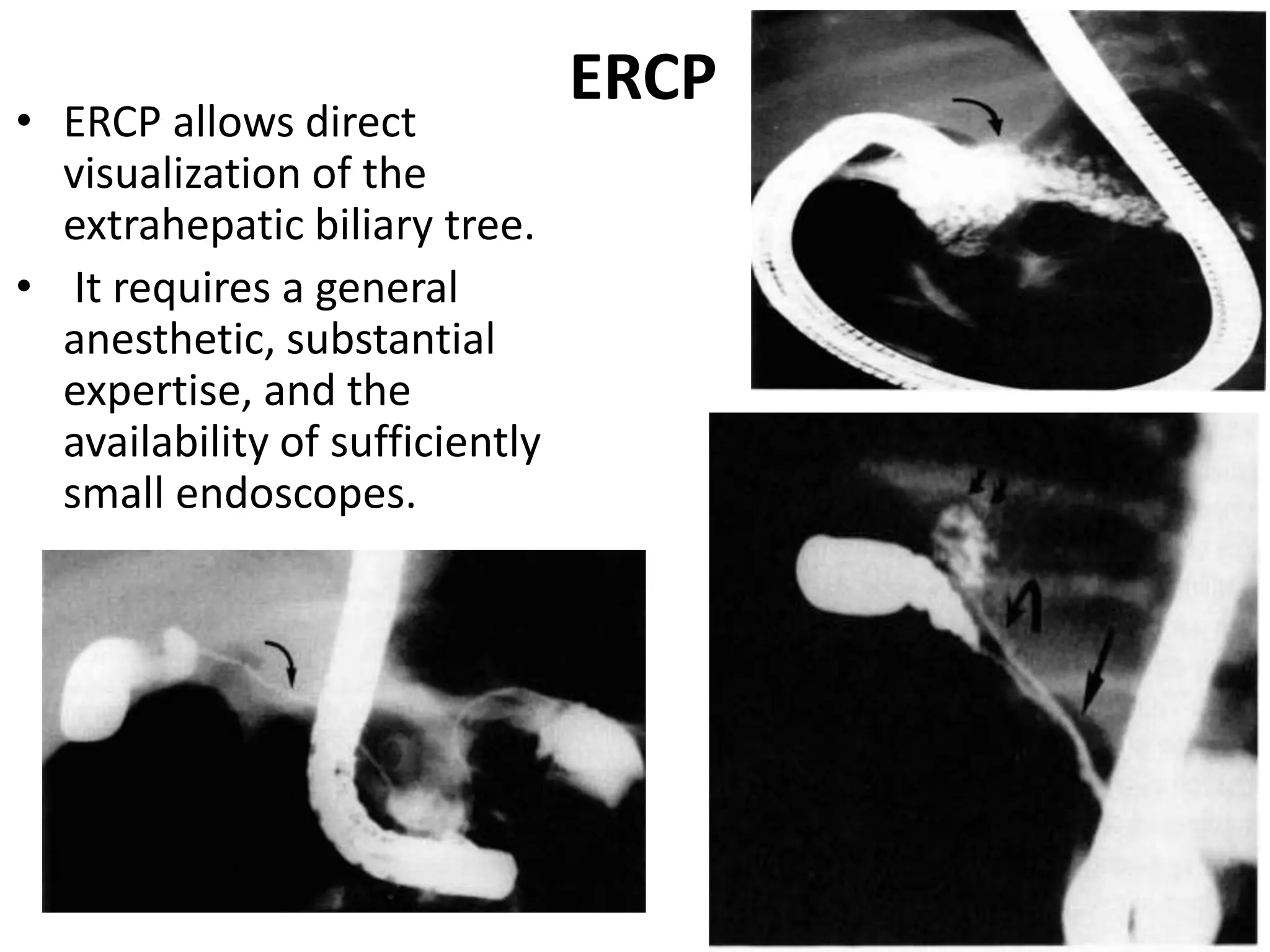 Extrahepatic biliary atresia | PPTX