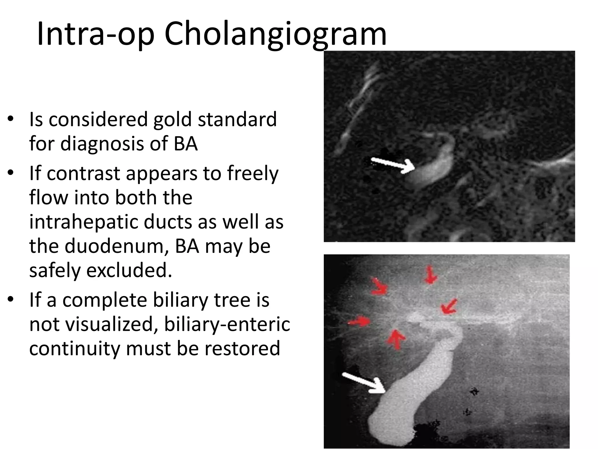 Extrahepatic biliary atresia | PPTX