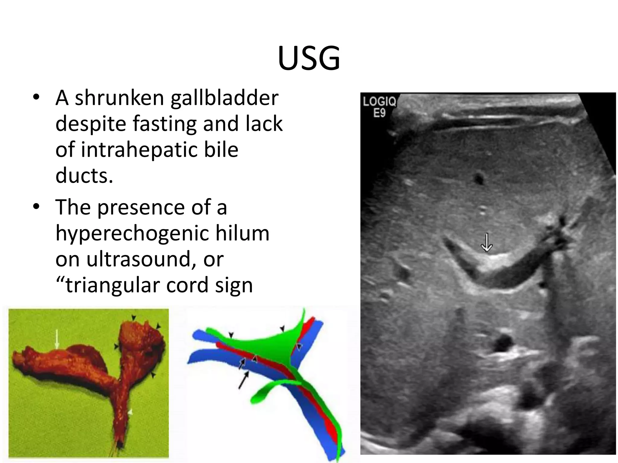 Extrahepatic biliary atresia | PPTX