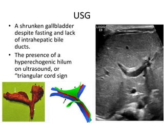 Extrahepatic biliary atresia | PPT