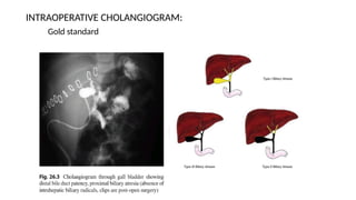EXTRAHEPATIC BILIARY ATRESIA D and M.pptx