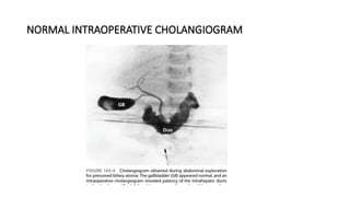 EXTRAHEPATIC BILIARY ATRESIA D and M.pptx