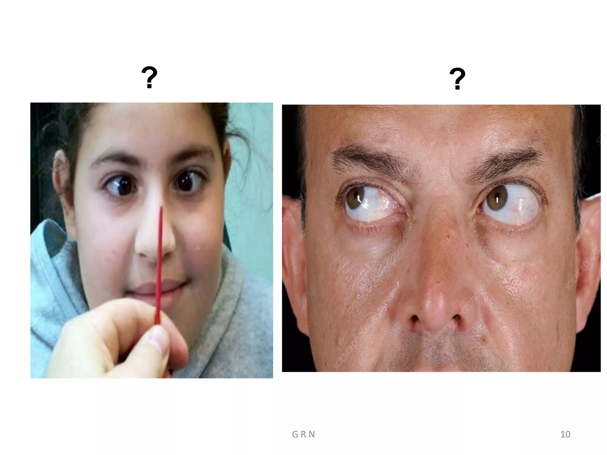 Extraocular muscles | PDF | Death, Injury, or Military Conflict ...