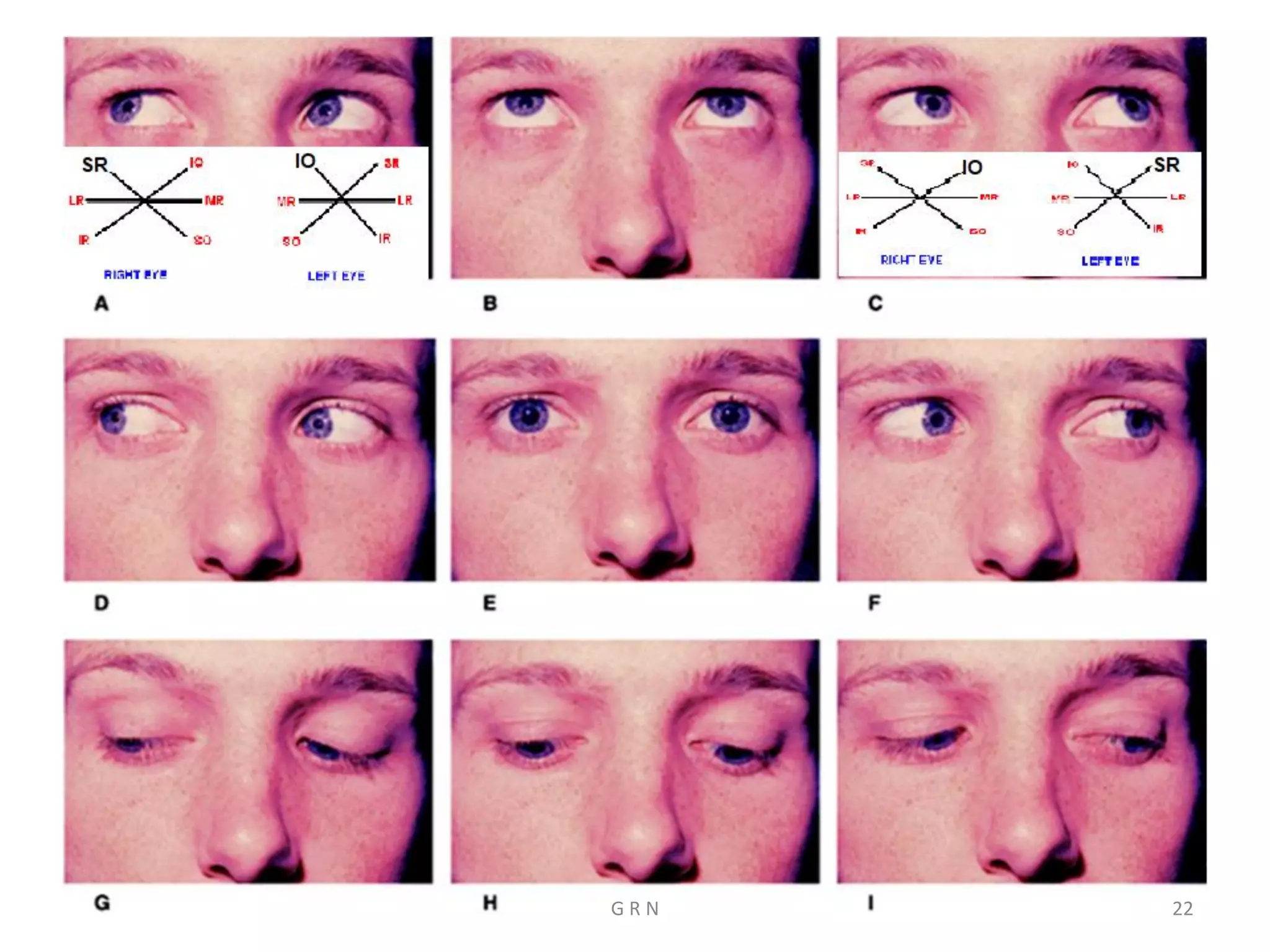 Extraocular muscles | PDF | Death, Injury, or Military Conflict ...