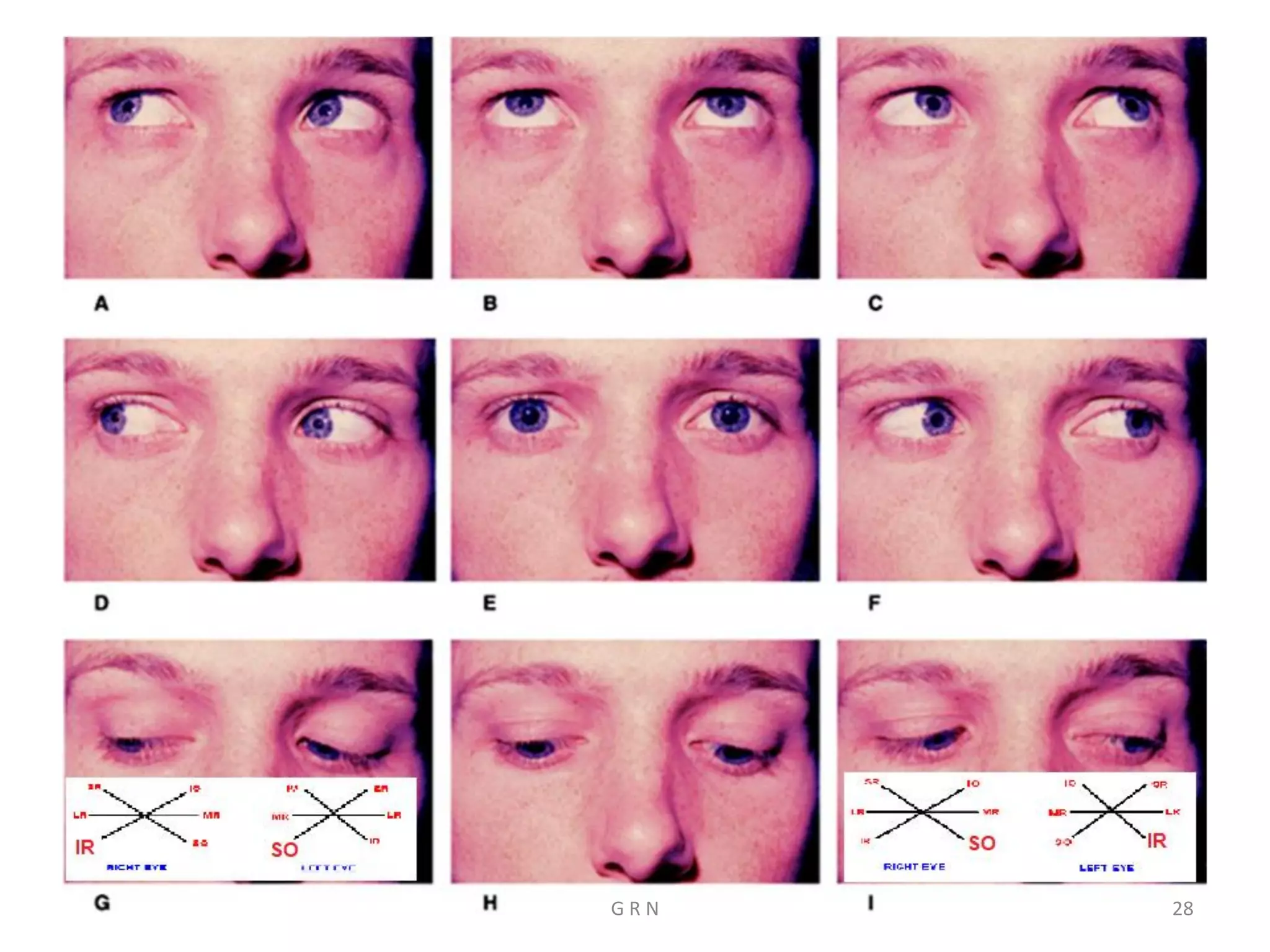Extraocular muscles | PDF | Death, Injury, or Military Conflict ...