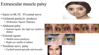 Extra ocular muscles | PDF