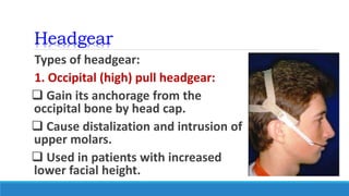 Extraoral appliances | PPTX