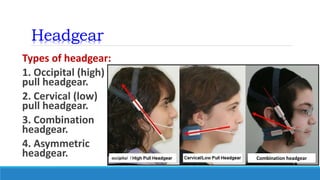 Extraoral appliances | PPTX