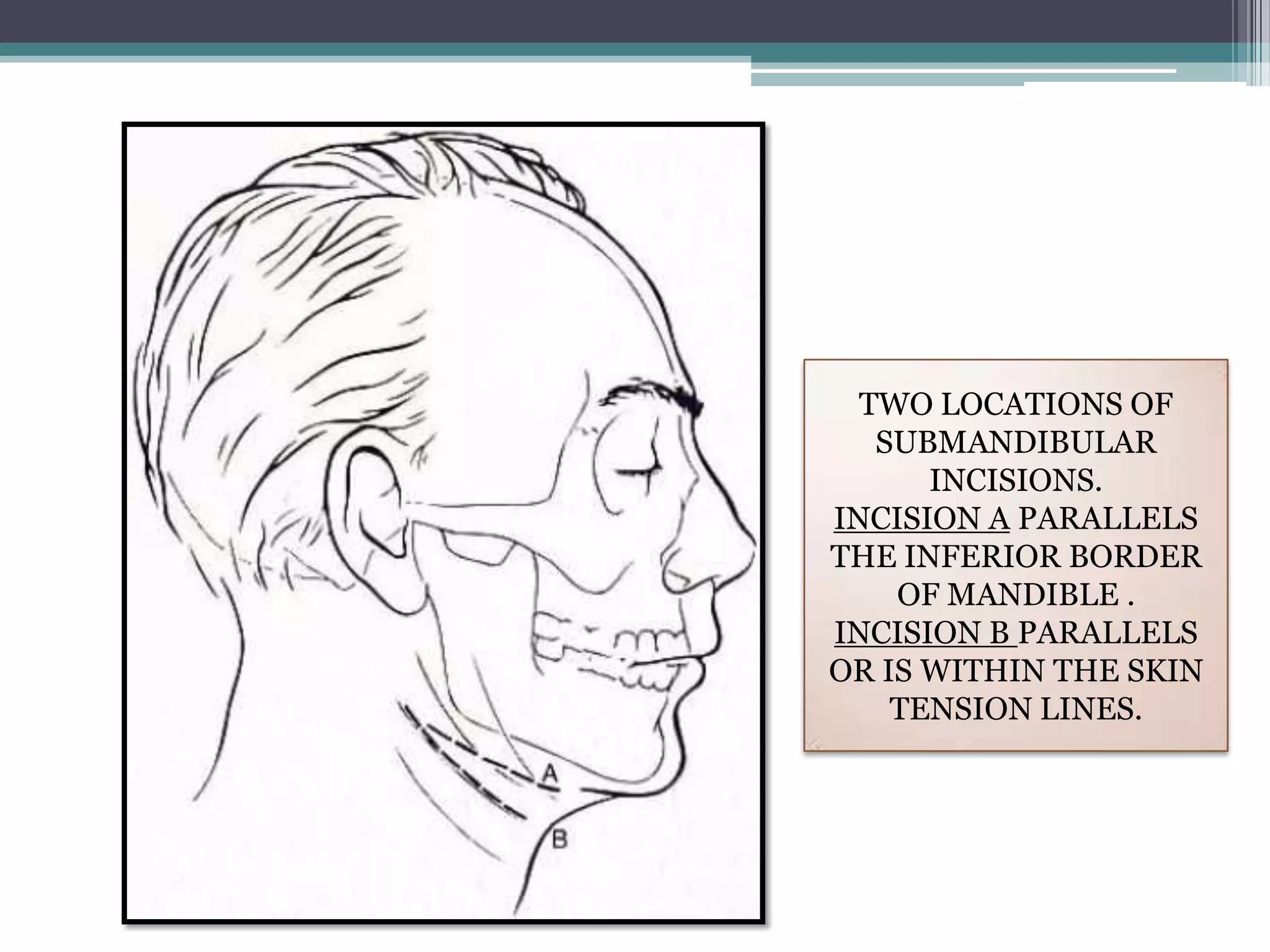 Extraoral mandibular approaches | PPTX