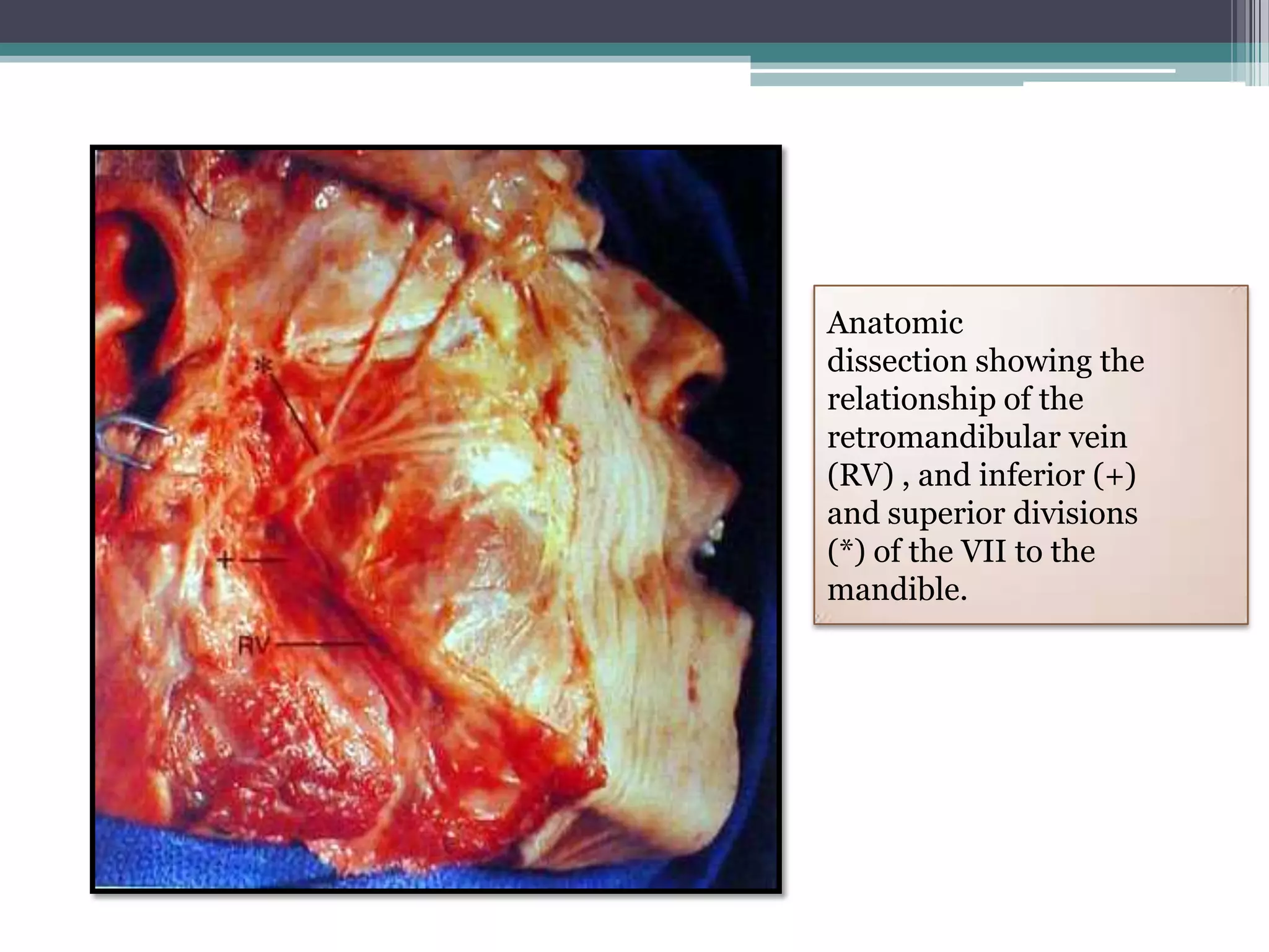 Extraoral mandibular approaches | PPTX