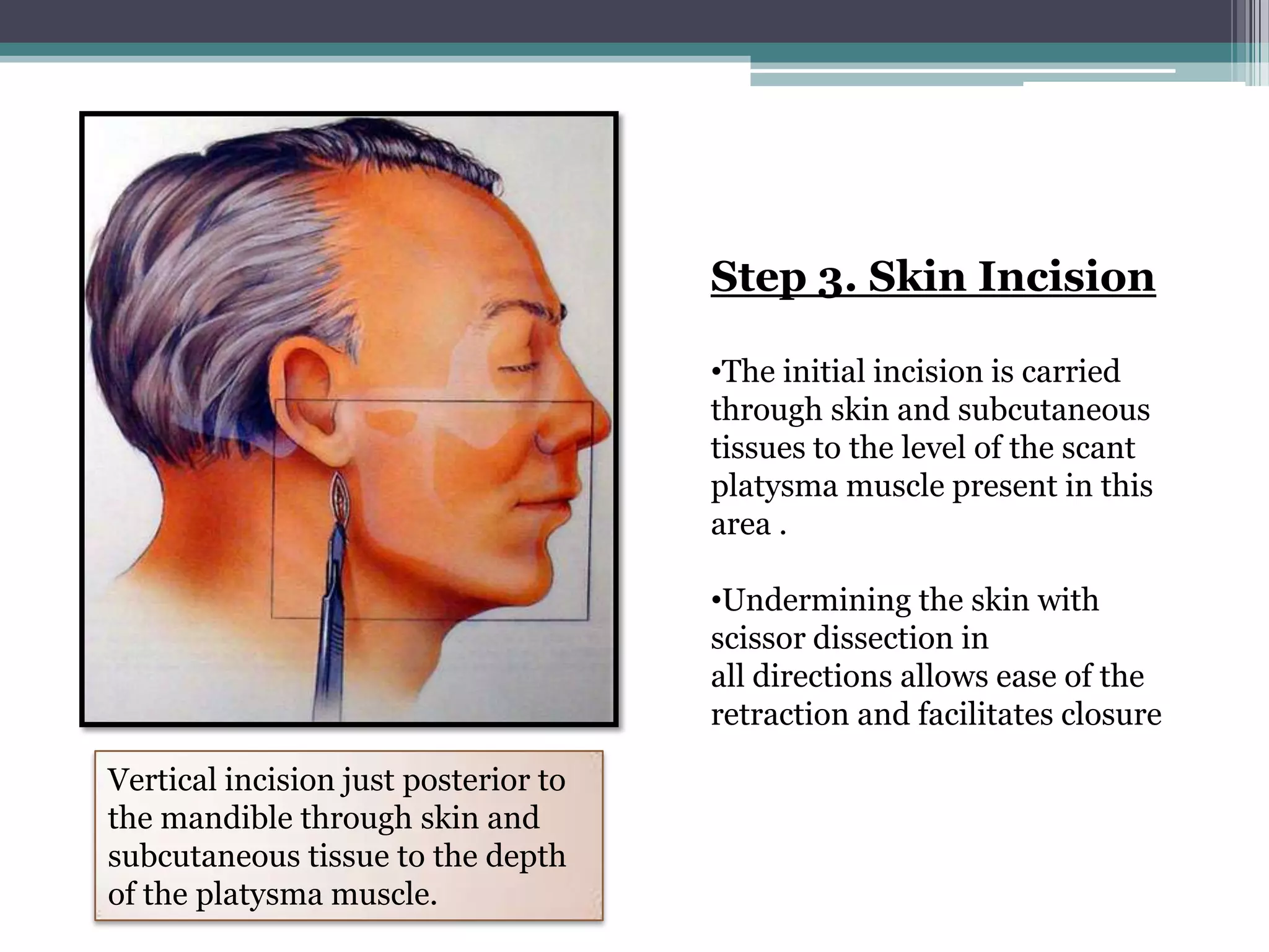 Extraoral mandibular approaches | PPTX
