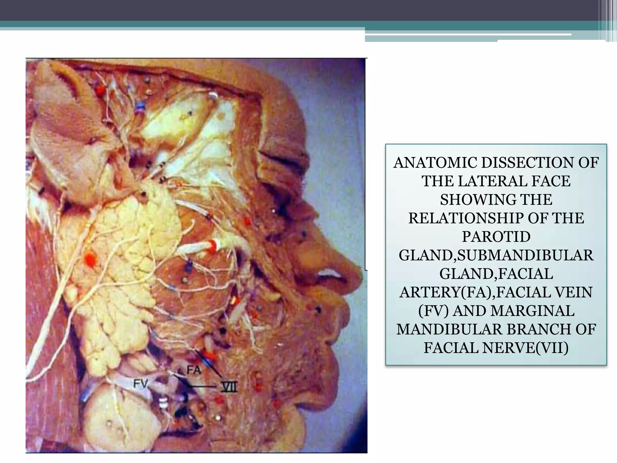 Extraoral mandibular approaches | PPTX