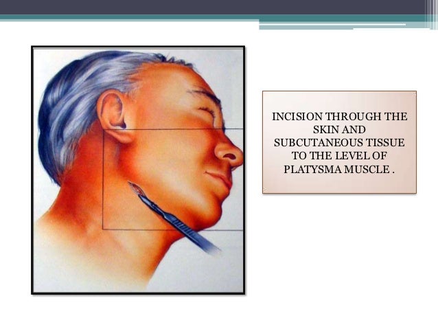 Extraoral mandibular approaches