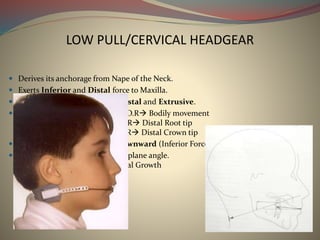 Extraoral orthopaedic appliance(headgear) | PPTX