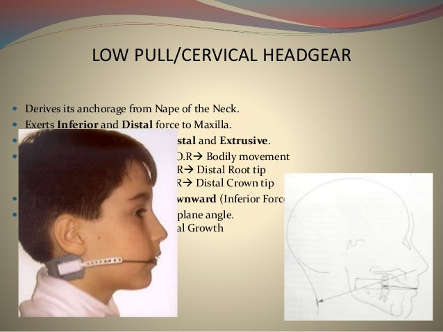 Extraoral orthopaedic appliance(headgear)