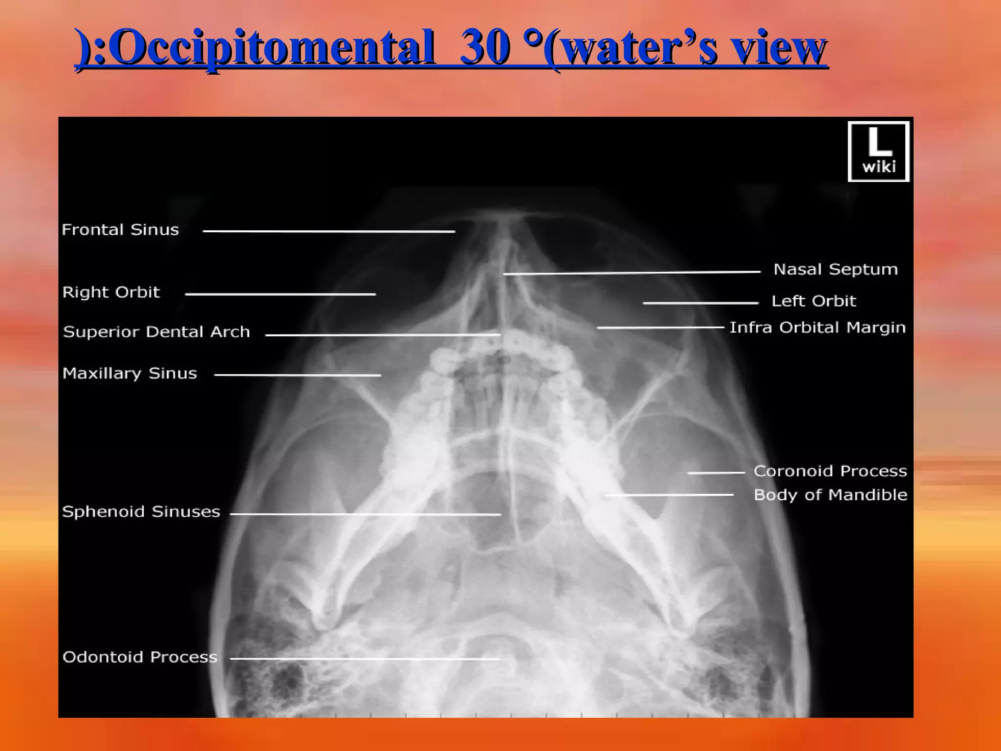 Extra-oral Radiology Techniques II | PPT