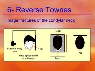 Extra-oral Radiology Techniques II | PPT