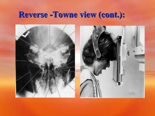 Extra-oral Radiology Techniques II | PPT