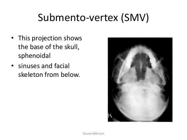 Extra oral radiograph
