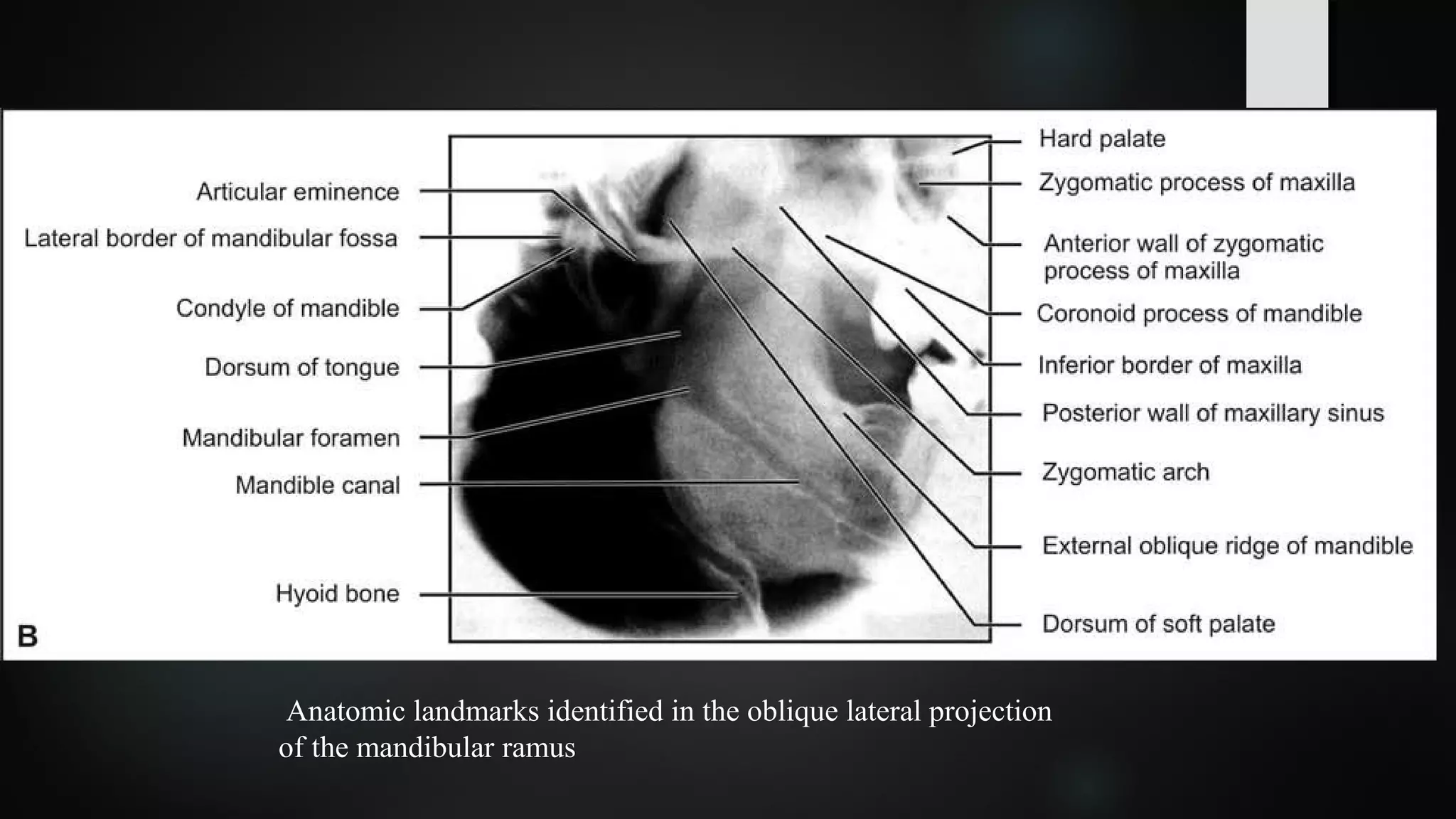 Extraoral radiograph lecture | PPT