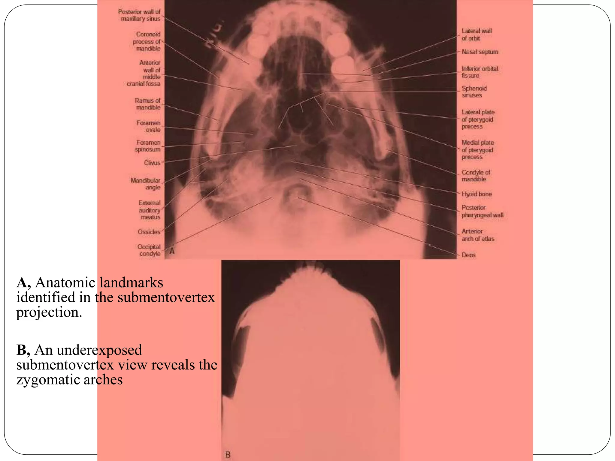 Extra-oral Radiographic Techniques | PPTX