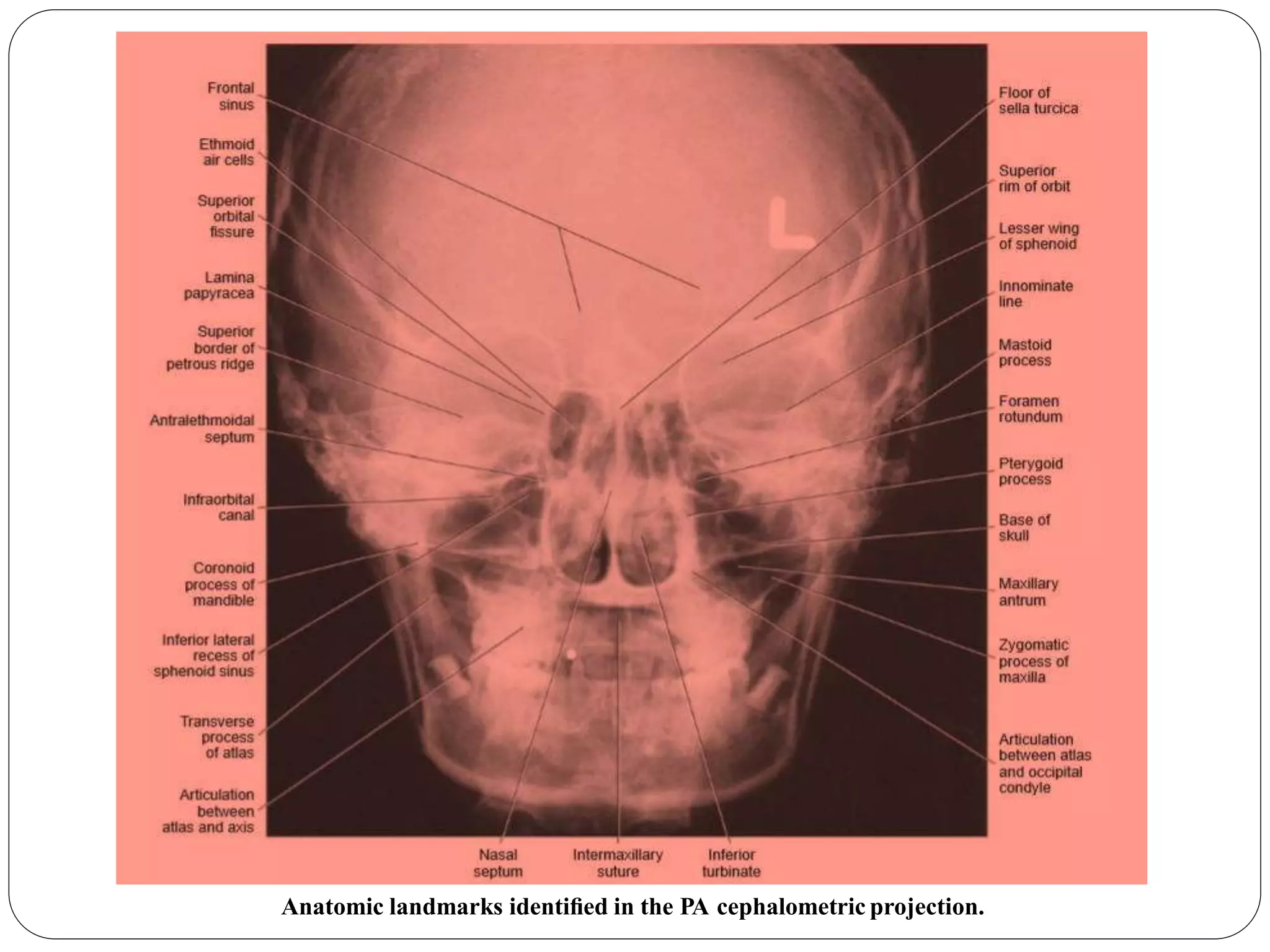 Extra-oral Radiographic Techniques | PPTX
