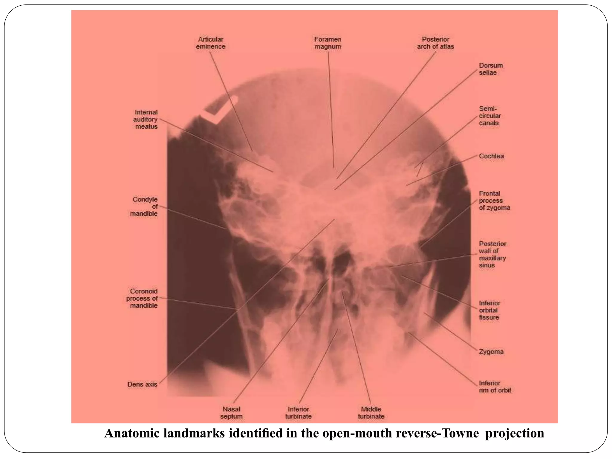 Extra-oral Radiographic Techniques | PPTX
