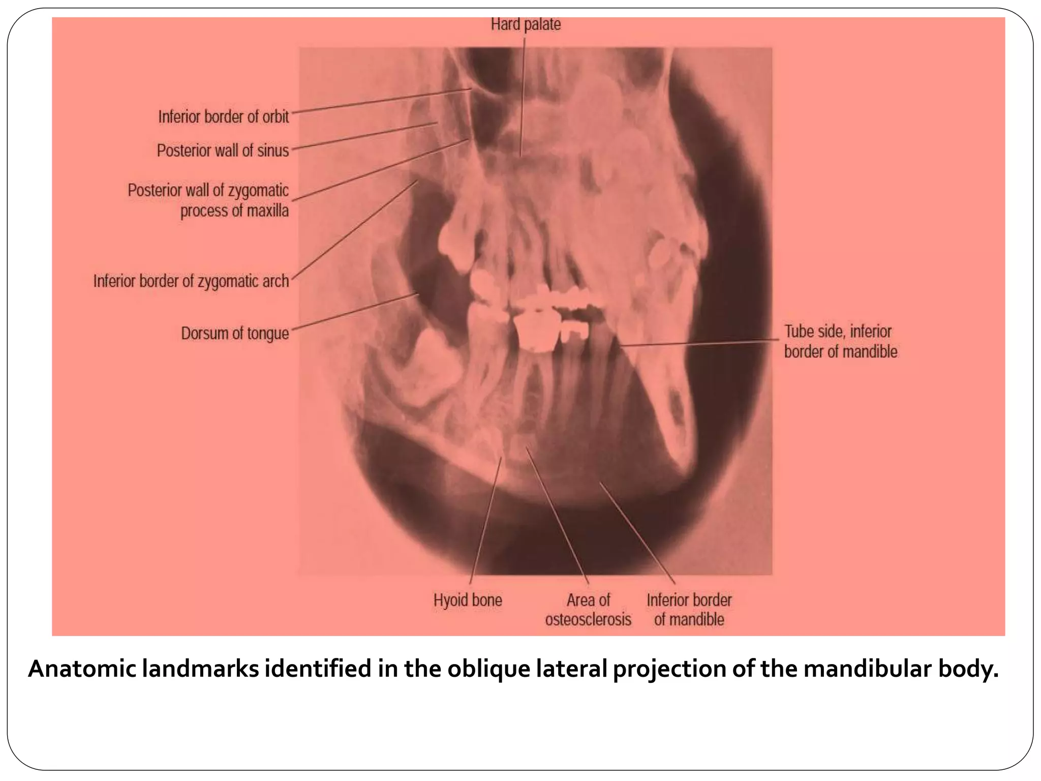 Extra-oral Radiographic Techniques | PPTX