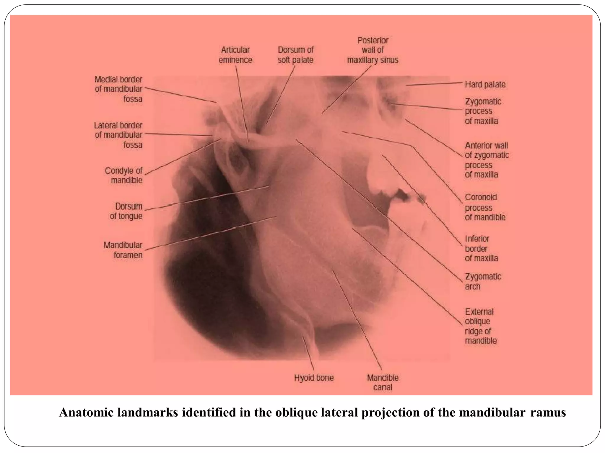 Extra-oral Radiographic Techniques | PPTX