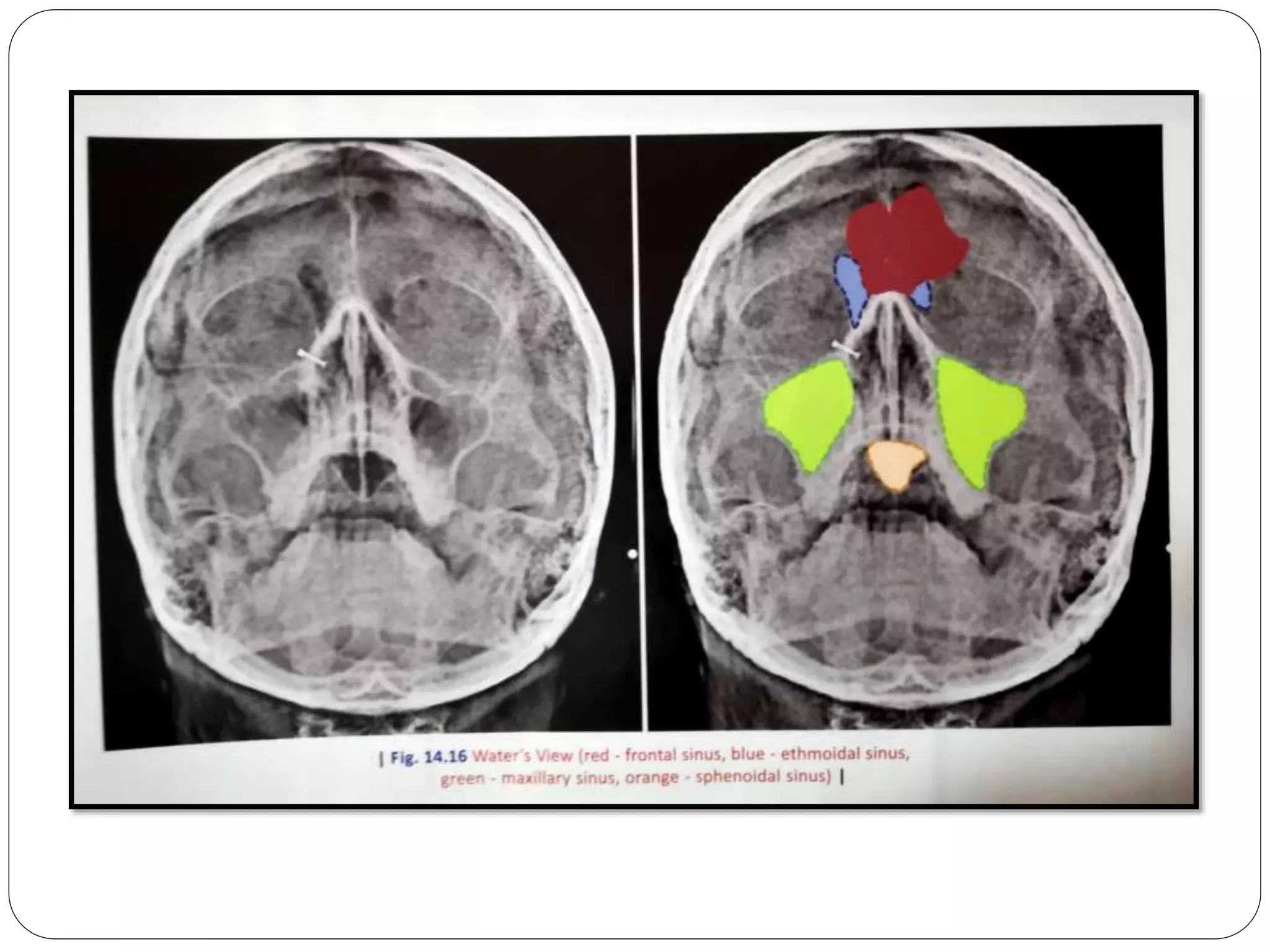 Extra-oral Radiographic Techniques | PPTX