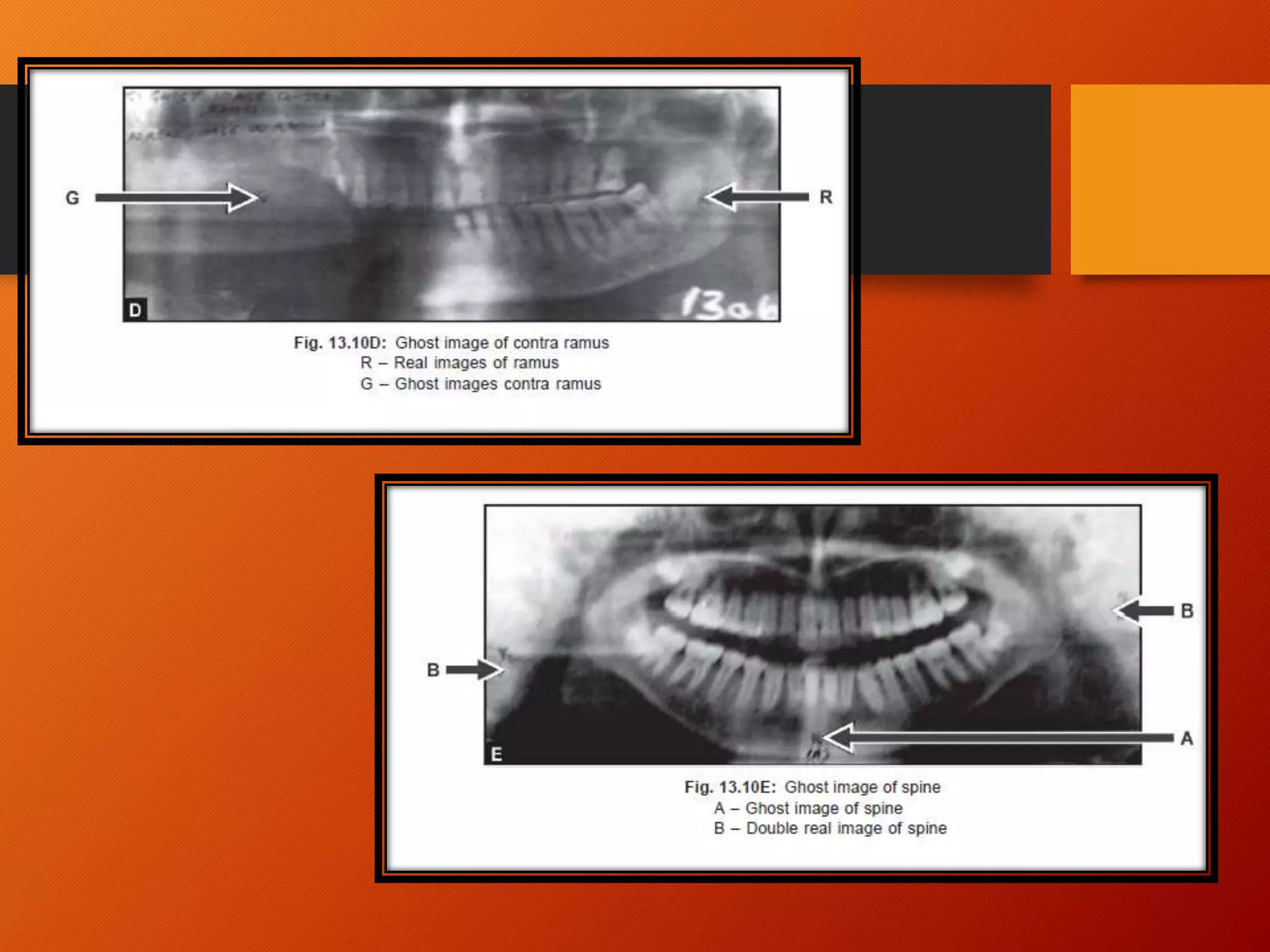 EXTRA ORAL RADIOGRAPHY | PPTX