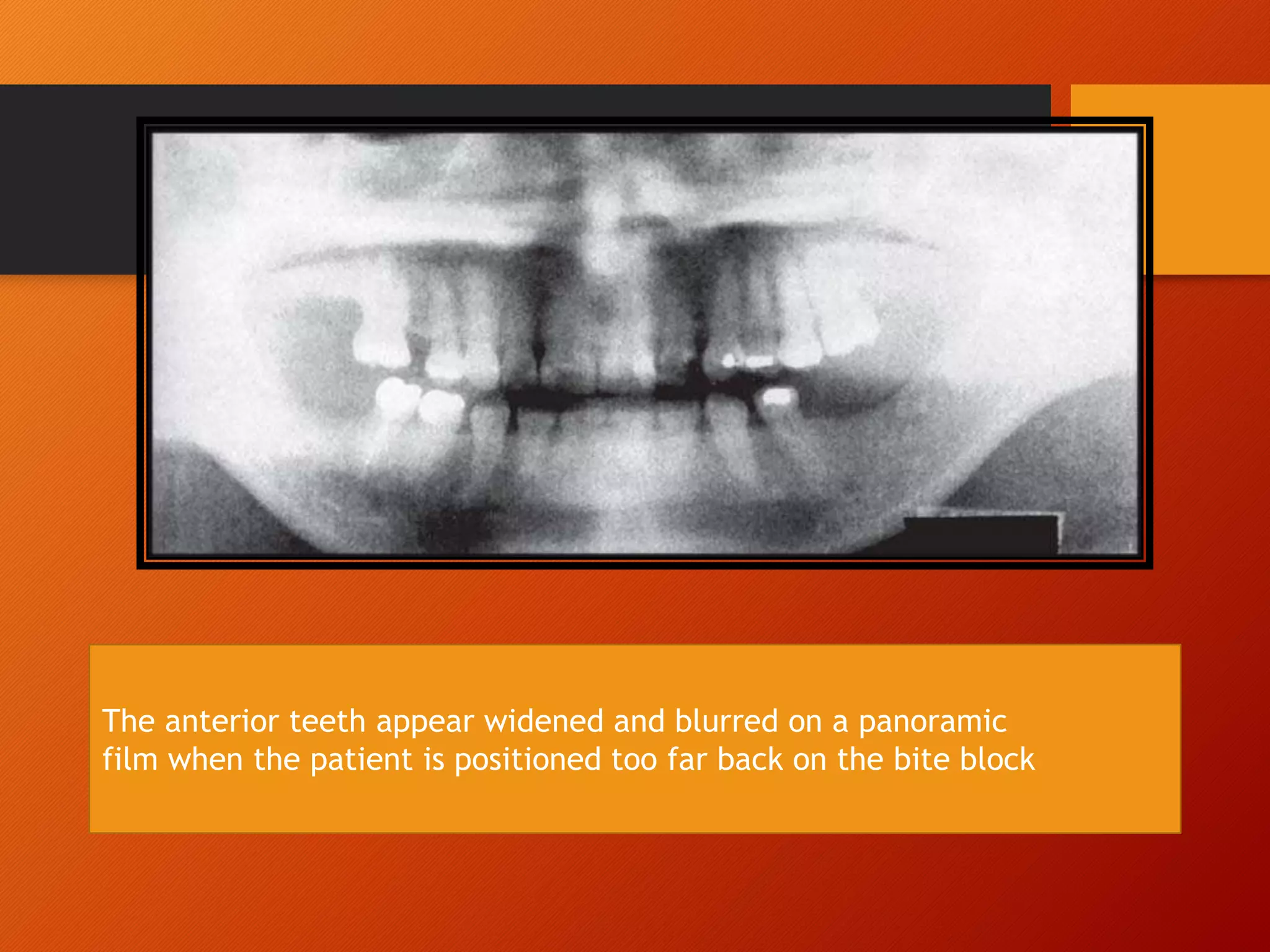EXTRA ORAL RADIOGRAPHY | PPTX