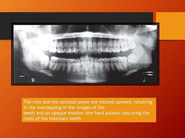 EXTRA ORAL RADIOGRAPHY | PPTX