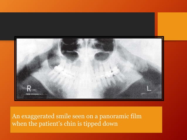 EXTRA ORAL RADIOGRAPHY | PPTX