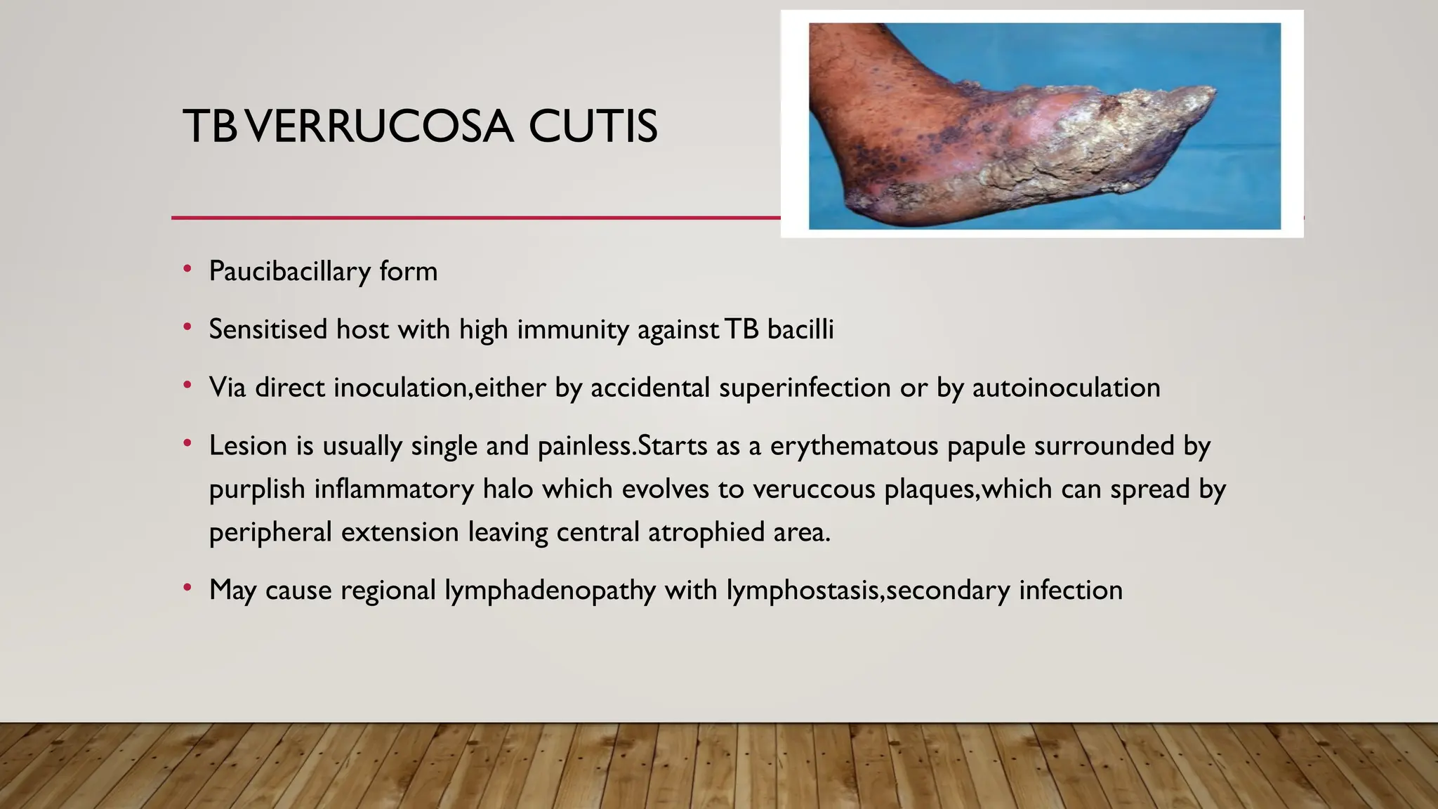 EXTRAPULMONARY TB clinical features and investigations | PPTX