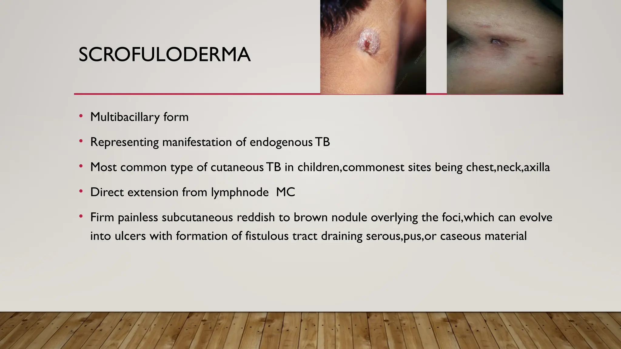EXTRAPULMONARY TB clinical features and investigations | PPTX