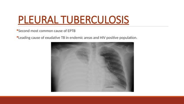 EXTRA PULMONARY TUBERCULOSIS clinical features | PPTX | Lung and ...