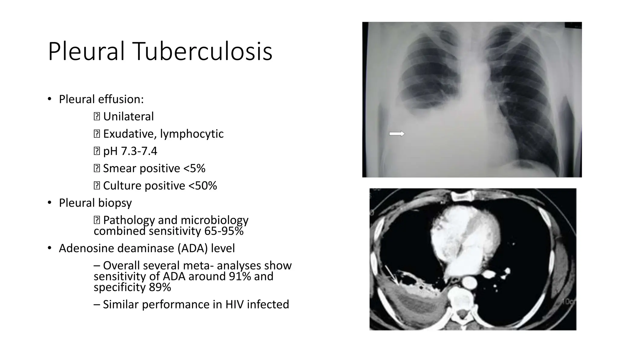 Extrapulmonary Tuberculosis_SRP.....pptx
