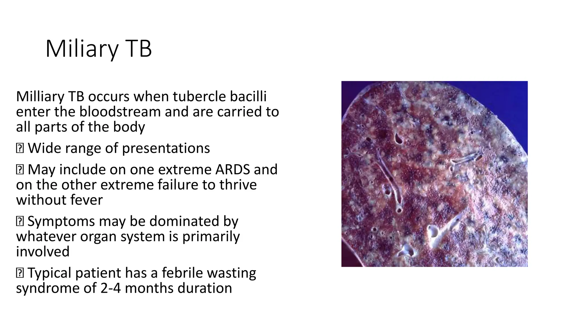 Extrapulmonary Tuberculosis_SRP.....pptx