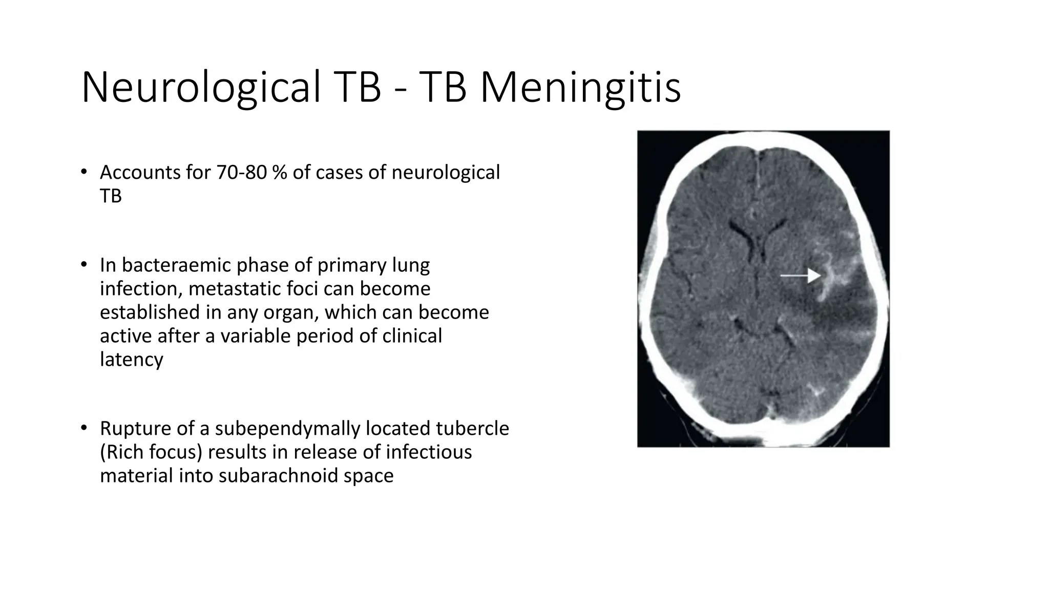 Extrapulmonary Tuberculosis_SRP.....pptx